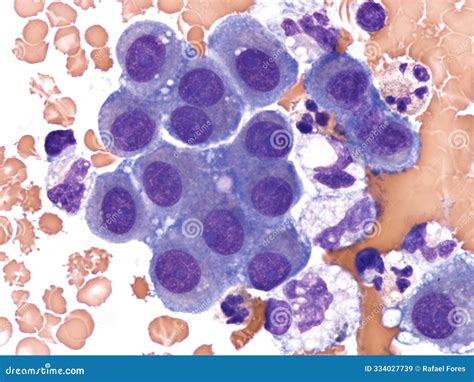 Mesothelial Cells In Pleural Fluid Stock Image Image Of Hyperplasia