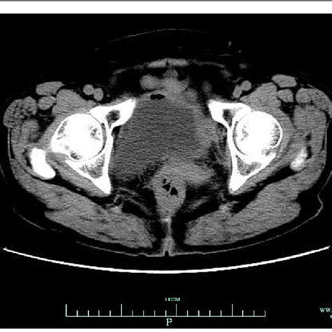 A The Sigmoid Colon Was Perforated And Fixed To The Left Abdominal Wall Download Scientific