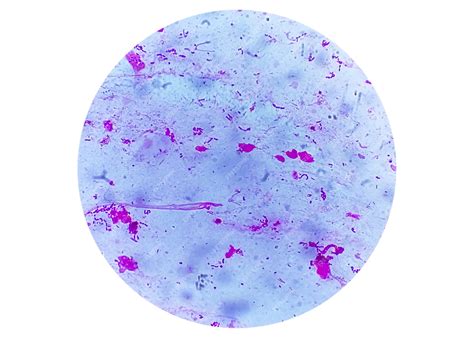 Gram Positive Diplococci