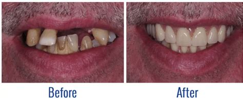 Immediate Dentures
