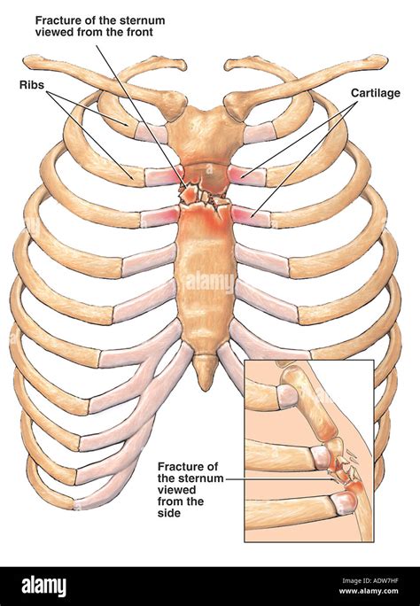 Broken Sternum X Ray