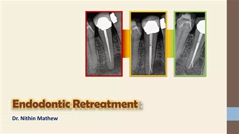 Endodontic Retreatment Pdf