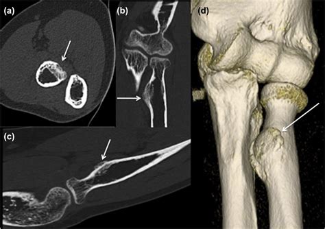 Heterotopic Ossification Related To The Radial Tuberosity A Tumour
