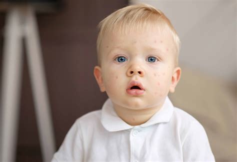 Measles Symptoms And Causes