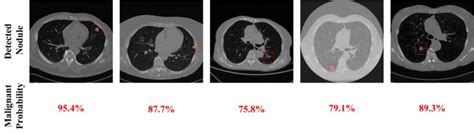 Visualization Of Nodule Classification Results On Test Set Download