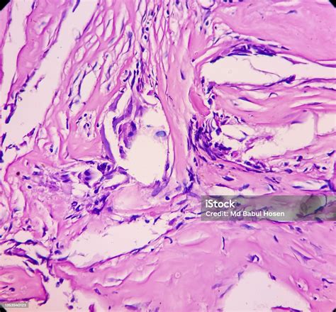 셀ar 병변에서 조직 현미경 검사법은 여러 젖은 각질 기저형 나타나는 세포 염증 세포 및 거대한 세포를 보여줍니다 진단 두개골 인두종 종양에 대한 스톡 사진 및 기타 이미지