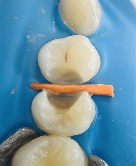 Conservative Composite Restoration Myzerodonto