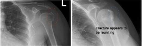 Proximal Humerus Fracture Boston Shoulder Institute