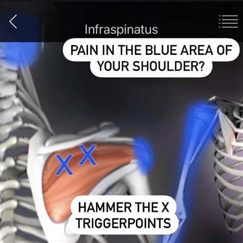 Infraspinatus Trigger Points Armored Heat App