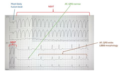 Left Bundle Branch Block Ecg Bifascicular Blocks What You Need To