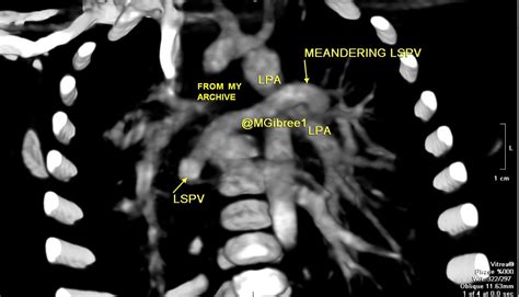 Meandering Pulmonary Vein Perfusfind