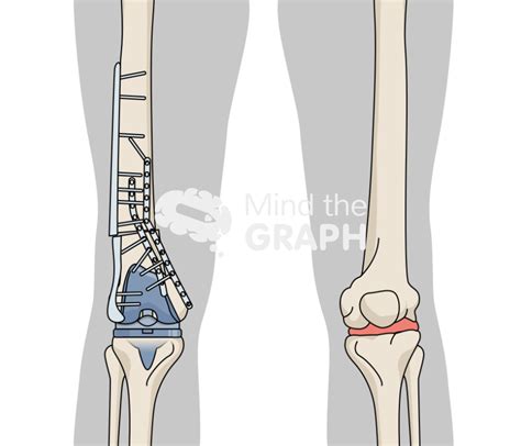 Failed Open Reduction Internal Fixation Periprosthetic Fracture Total