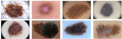 논문 리뷰 Web Based Melanoma Detection