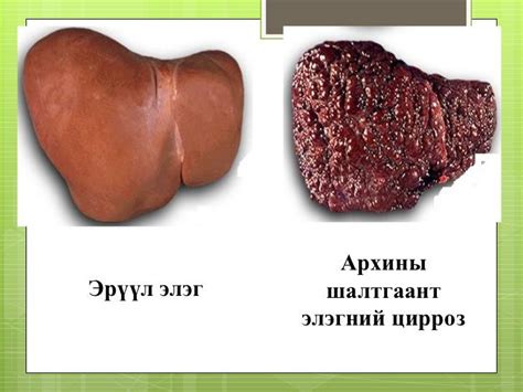 Циррозыг сэжиглэх шинж Элэгний Шагдарсүрэн эмнэлэг