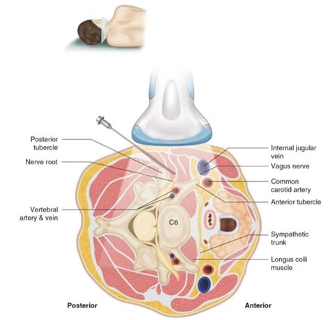 Cervical Spinal Nerve Roots