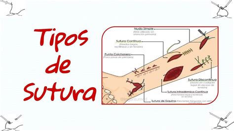 Tipos De Suturas Fred Udocz