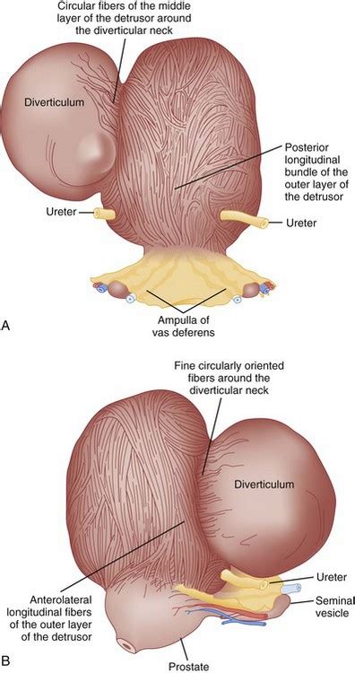 Bladder And Female Urethral Diverticula Abdominal Key