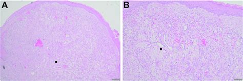 Capillary Malformation A Low Power 4 Â View Shows The Increased Download Scientific Diagram
