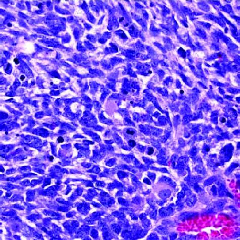 Pdf Malignant Thyroid Teratoma