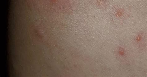 Bug Bite Or Rash Identification