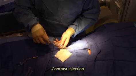 Indirect Carotid Cavernous Fistula Treated With Pipeline Embolization Device Ped Youtube