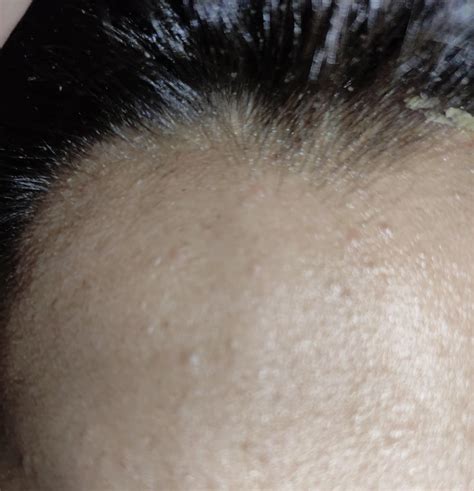 Ts Seborrheic Dermatitis Right C R Dermatologyquestions