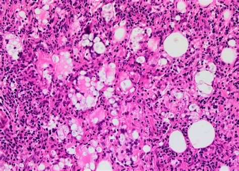 Cryptococcus Histology