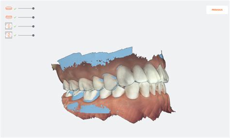 Automatic Bite Alignment 3disc Online Help