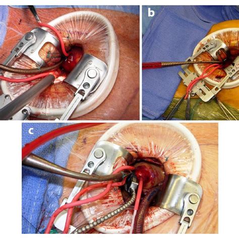 Central Aortic Cannulation A The Aorta Is Directly Cannulated Download Scientific Diagram