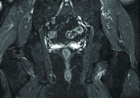 Adductor Muscles Mri
