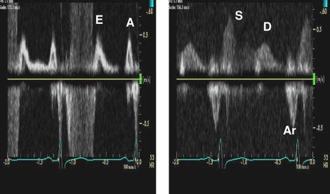 Recording Of Mitral Inflow At The Level Of The Annulus Left And Download Scientific Diagram