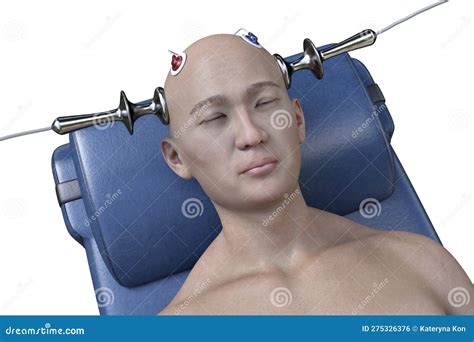 Electroconvulsive Therapy Ect A Treatment Involving The Use Of
