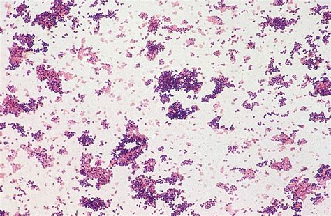 Infection à Streptococcus Suis Agent Pathogène Base De Données