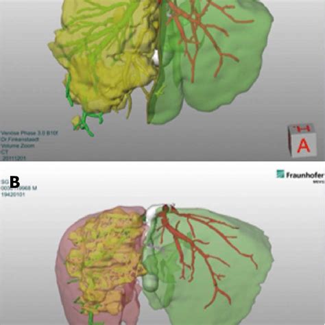 Associating Liver Partition And Portal Vein Ligation For Staged Download Table