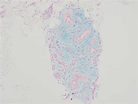 Chronic Eczematous Dermatitis With Prominent Secondary Peri Eccrine
