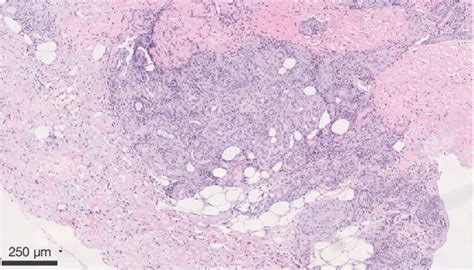 Hande Section Shows The Deep Aspects Of The Dermis With Vasculitis With Download Scientific