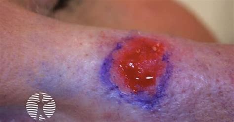 Basal Cell Carcinoma Affecting The Nose Image Basal Cell Carcinoma Affecting The Nose Image