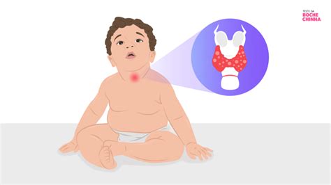 Hipotiroidismo Congénito Genética Diagnóstico Y Tratamiento