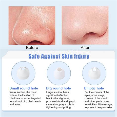 Blackhead Under Microscope