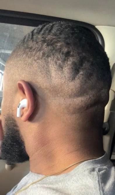 Scalp Reduction Surgery R Cvgsupportgroup