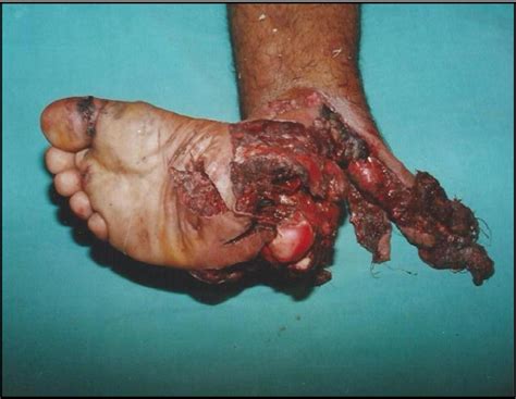 Figure 1 From Below Knee Long Stump Guillotine Amputation For Mine