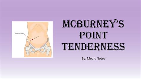 Mcburneys Point Tenderness Youtube