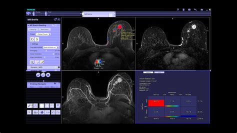 Breast Mri Siemens Healthineers Usa