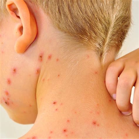 Chicken Pox Stages