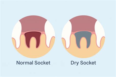 Normal Socket Vs Dry Socket Understanding The Differences Northland