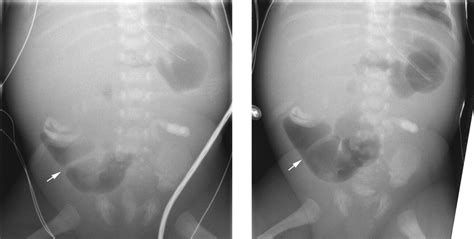 Small Bowel Obstruction X Ray