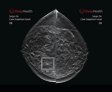 New Ai Technology Aids Breast Cancer Detection In Delaware