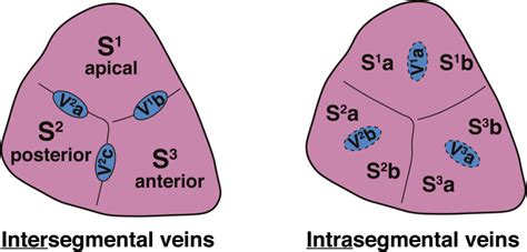 Right Upper Lobe Segmentectomy Guided By Simplified Anatomic Models Pmc