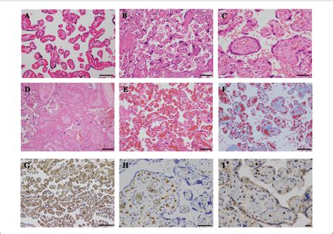 Representative Images Showing Findings In Placental Specimens A Download Scientific Diagram