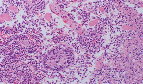 The 10 Signs Of Dying From Aspiration Pneumonia 2025